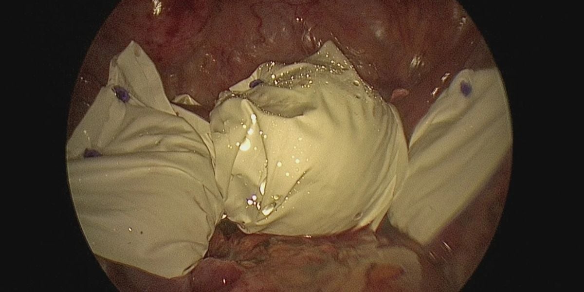 adhesion examples medical